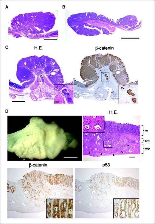Mouse Model of Colonic Adenoma-Carcinoma Progression Based on Somatic ...