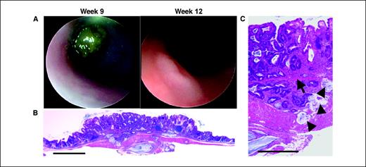 Flat Colorectal Cancers Are Genetically Determined and Progress to ...
