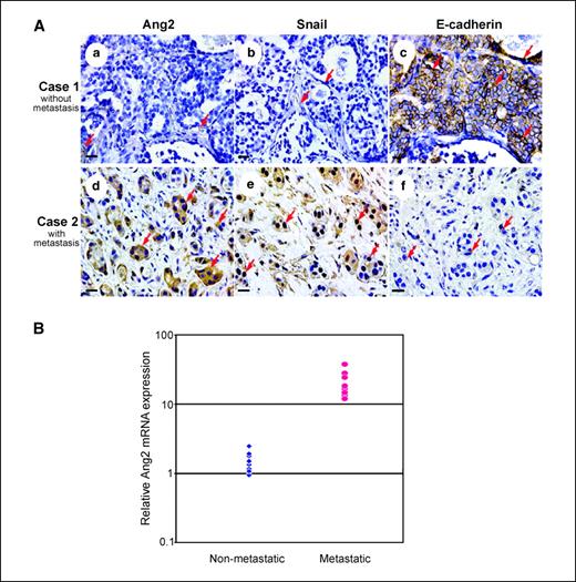Angiopoietin-2 Stimulates Breast Cancer Metastasis through the α5β1 ...