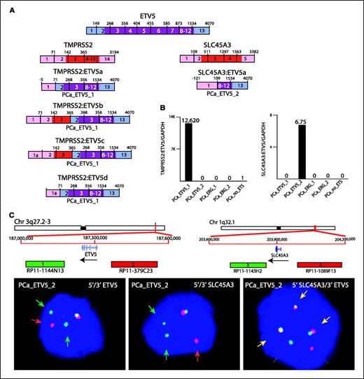 Characterization of TMPRSS2:ETV5 and SLC45A3:ETV5 Gene Fusions in ...