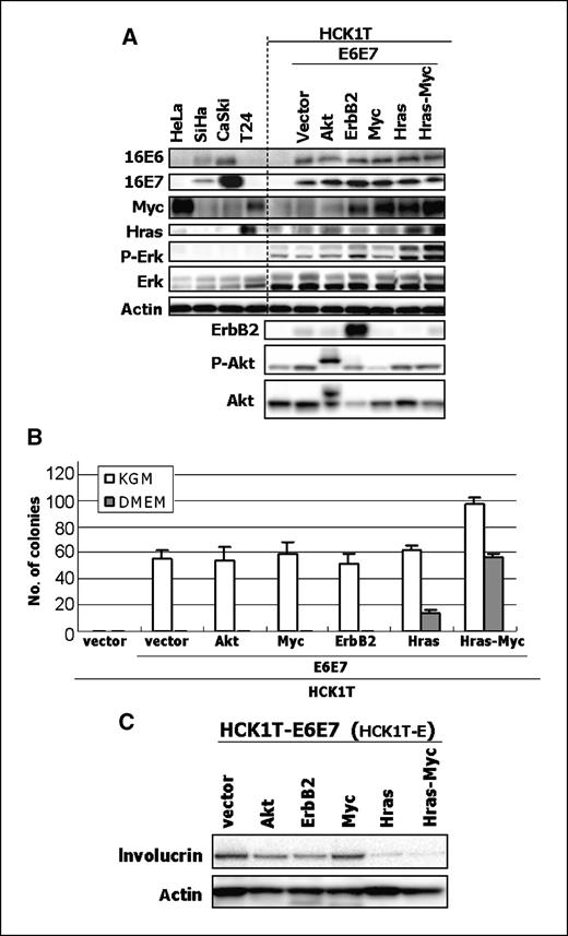 An In vitro Multistep Carcinogenesis Model for Human Cervical Cancer ...