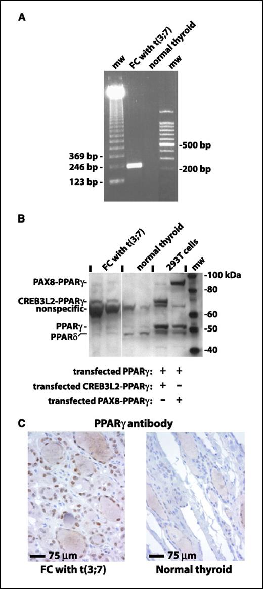 CREB3L2-PPARγ Fusion Mutation Identifies a Thyroid Signaling Pathway ...