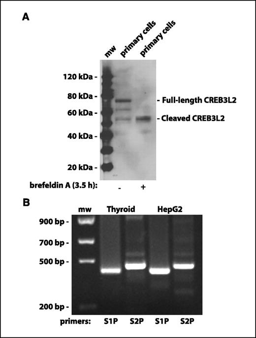 CREB3L2-PPARγ Fusion Mutation Identifies a Thyroid Signaling Pathway ...