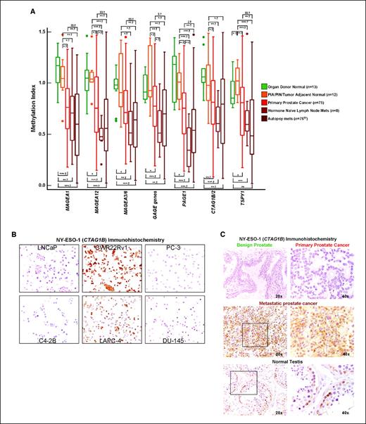 DNA Hypomethylation Arises Later in Prostate Cancer Progression than ...