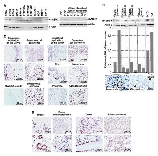 The Human Trithorax Protein hASH2 Functions as an Oncoprotein | Cancer ...