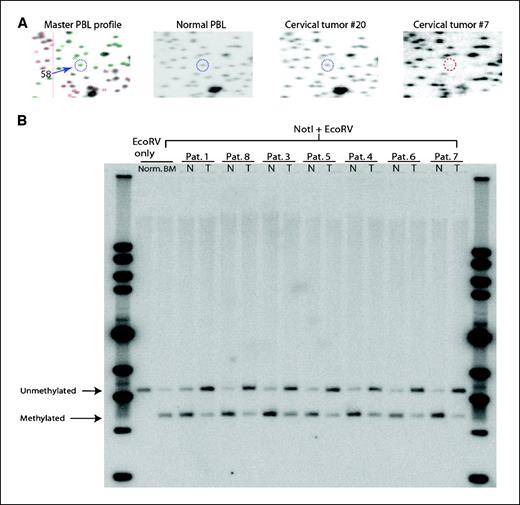 Identification of Novel Methylation Markers in Cervical Cancer Using ...