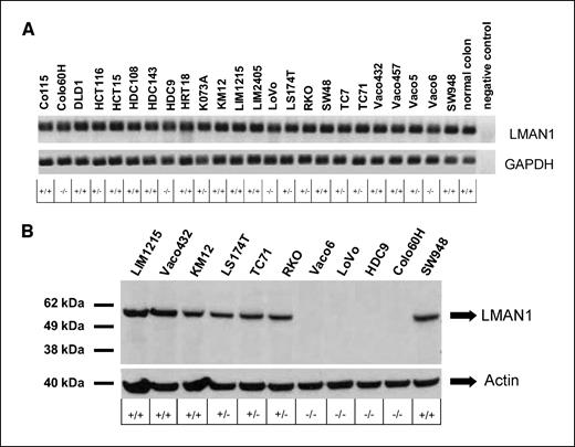 High Frequency of LMAN1 Abnormalities in Colorectal Tumors with ...