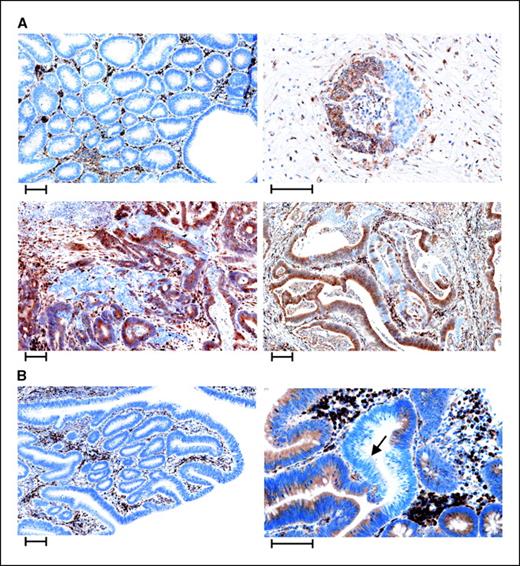 High Frequency of LMAN1 Abnormalities in Colorectal Tumors with ...