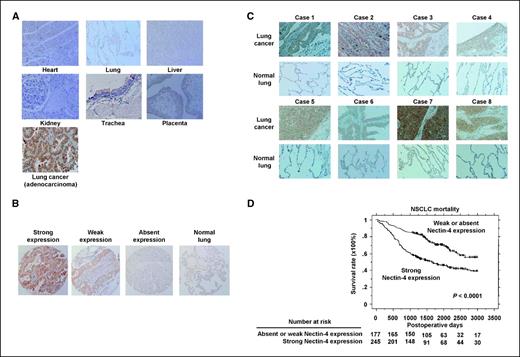 Identification of Nectin-4 Oncoprotein as a Diagnostic and Therapeutic ...