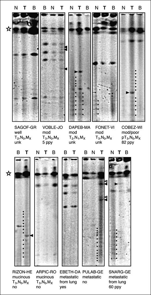 Human rRNA Gene Clusters Are Recombinational Hotspots in Cancer ...