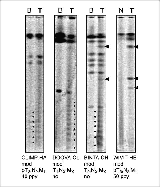 Human rRNA Gene Clusters Are Recombinational Hotspots in Cancer ...