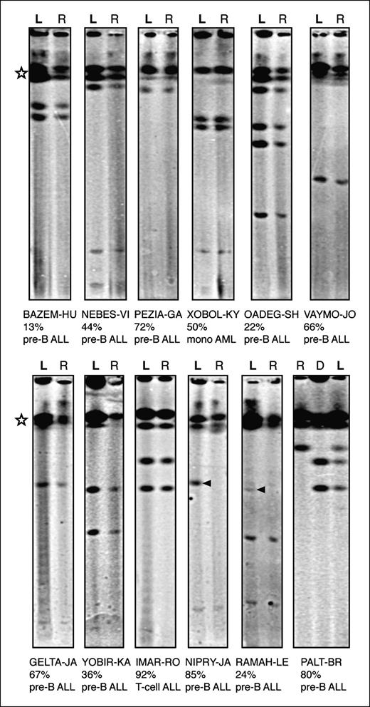 Human rRNA Gene Clusters Are Recombinational Hotspots in Cancer ...