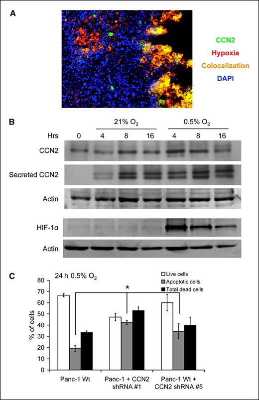 The Role of Tumor Cell–Derived Connective Tissue Growth Factor (CTGF ...