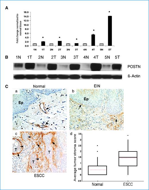 Periostin, a Cell Adhesion Molecule, Facilitates Invasion in the Tumor ...