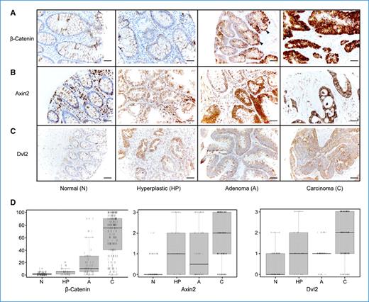 Dvl2 Promotes Intestinal Length and Neoplasia in the ApcMin Mouse Model ...