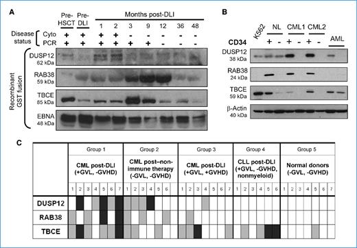 Efficacious Immune Therapy in Chronic Myelogenous Leukemia (CML ...