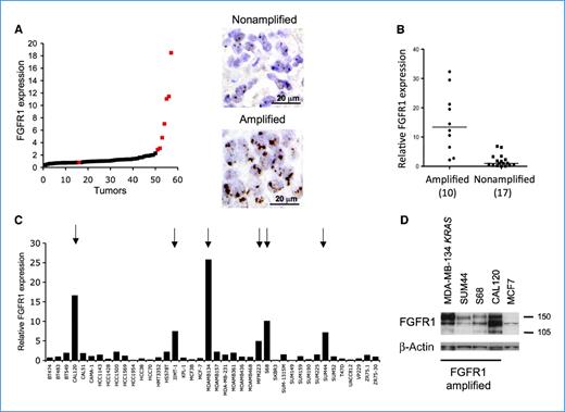 FGFR1 Amplification Drives Endocrine Therapy Resistance and Is a ...