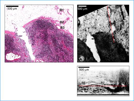 Imaging of Human Lymph Nodes Using Optical Coherence Tomography ...