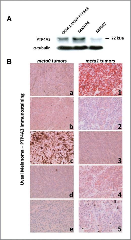 High PTP4A3 Phosphatase Expression Correlates with Metastatic Risk in ...