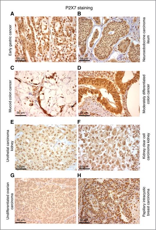 Expression of P2X7 Receptor Increases In Vivo Tumor Growth | Cancer ...