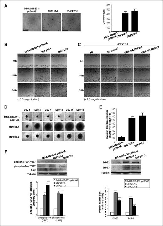 ZNF217 Is a Marker of Poor Prognosis in Breast Cancer That Drives ...