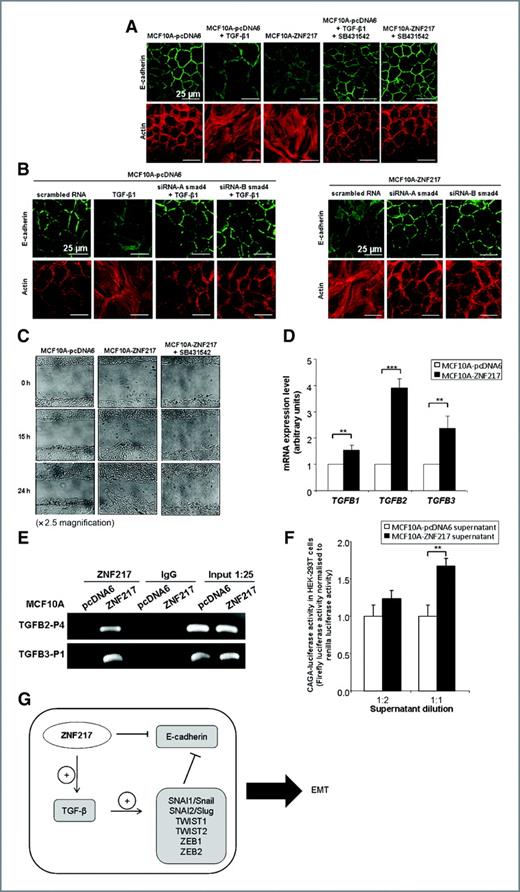 ZNF217 Is a Marker of Poor Prognosis in Breast Cancer That Drives ...