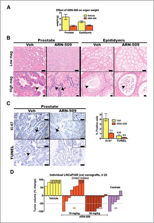 ARN-509: A Novel Antiandrogen for Prostate Cancer Treatment | Cancer ...