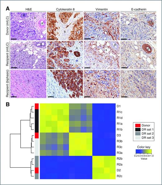 A Preclinical Mouse Model of Invasive Lobular Breast Cancer Metastasis ...