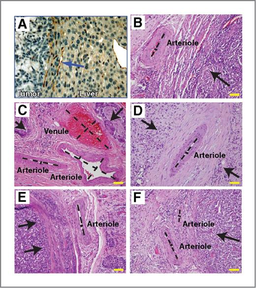 Coevolution of Solid Stress and Interstitial Fluid Pressure in Tumors ...