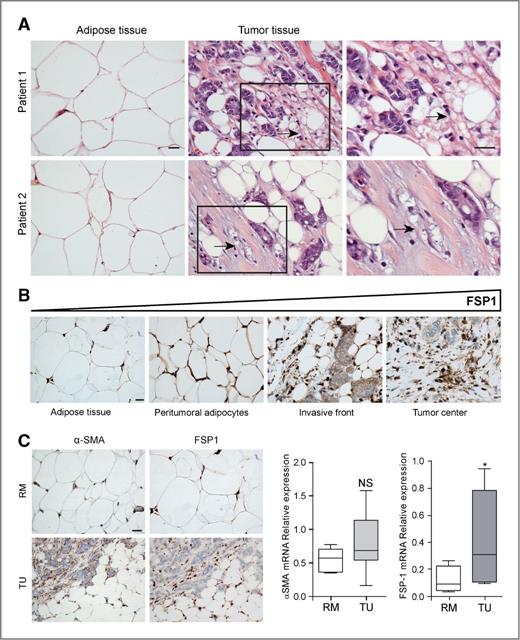 Adipocyte-Derived Fibroblasts Promote Tumor Progression and Contribute ...