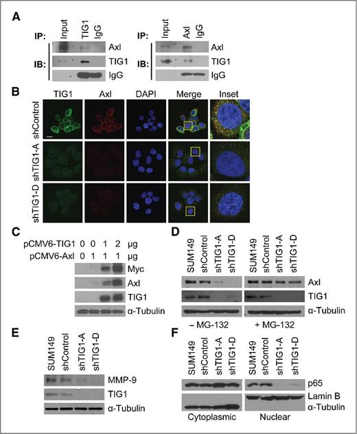 TIG1 Promotes the Development and Progression of Inflammatory Breast ...