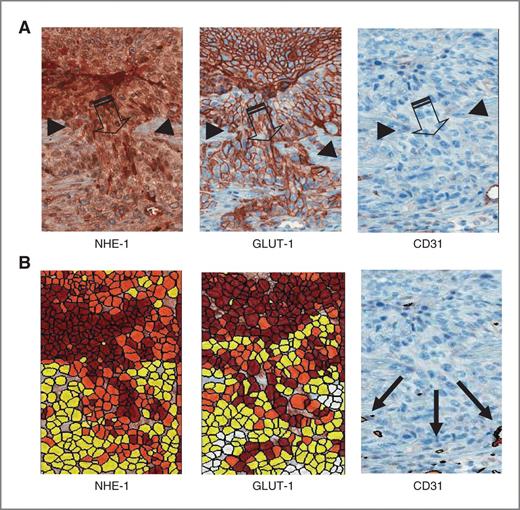 Acidity Generated by the Tumor Microenvironment Drives Local Invasion ...