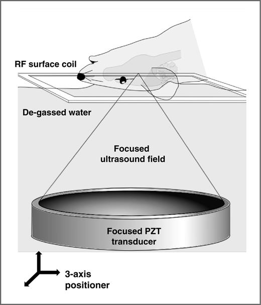 Focused Ultrasound Delivers Targeted Immune Cells to Metastatic Brain ...