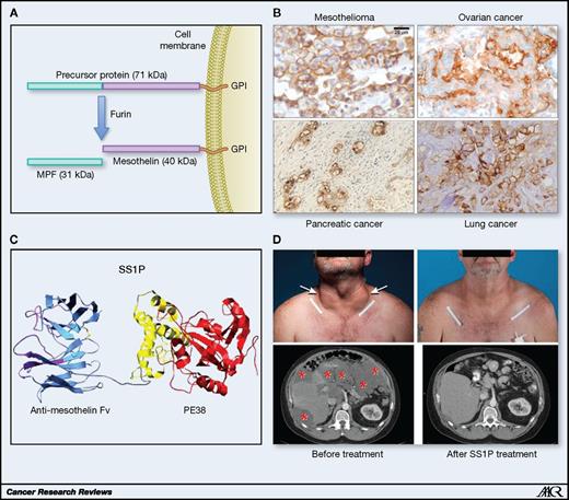 Discovery of Mesothelin and Exploiting It as a Target for Immunotherapy ...