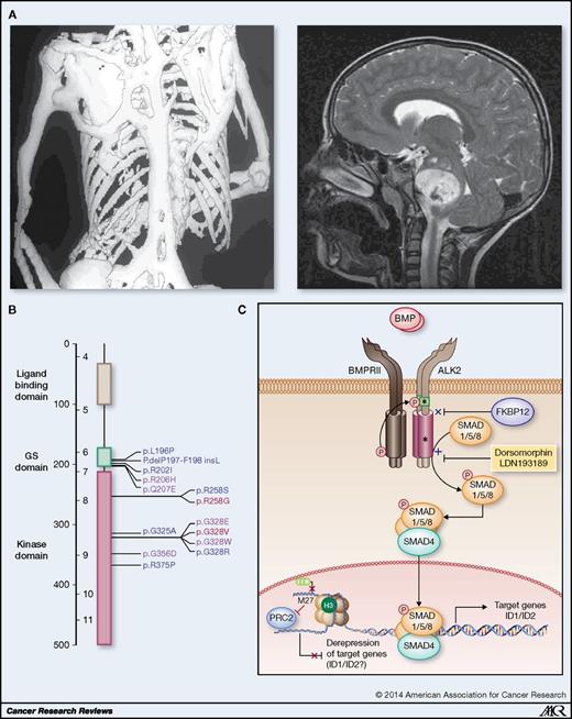 ACVR1 Mutations in DIPG: Lessons Learned from FOP | Cancer Research ...