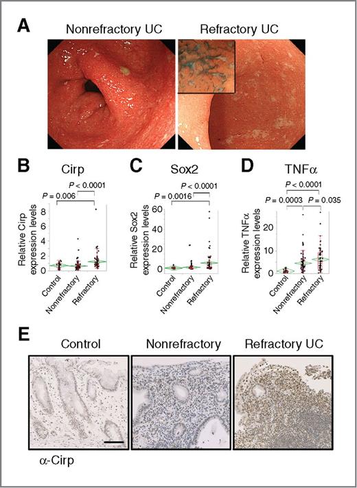 Stress Response Protein Cirp Links Inflammation and Tumorigenesis in Colitis-Associated Cancer ...
