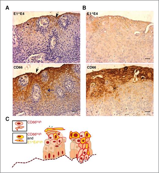 CD66+ Cells in Cervical Precancers Are Partially Differentiated ...