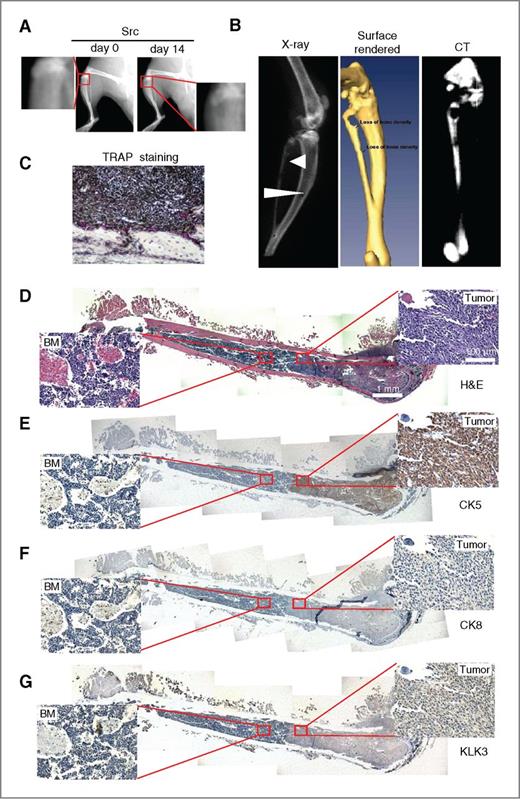 CCR5 Receptor Antagonists Block Metastasis to Bone of v-Src Oncogene ...
