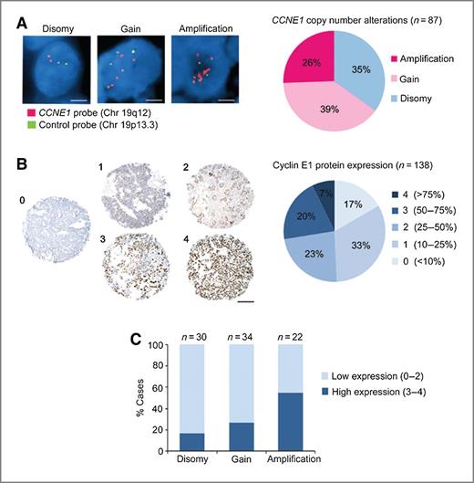 Cyclin E1 Deregulation Occurs Early in Secretory Cell Transformation to ...