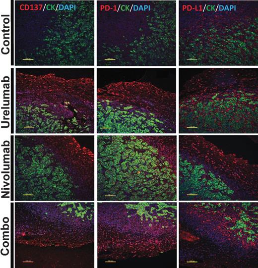 Nivolumab and Urelumab Enhance Antitumor Activity of Human T ...
