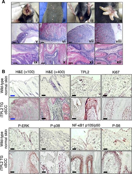 TPL2 Is an Oncogenic Driver in Keratocanthoma and Squamous Cell ...