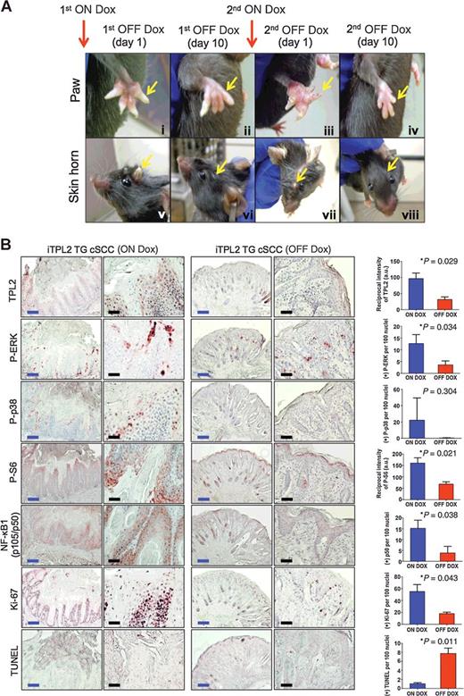 TPL2 Is an Oncogenic Driver in Keratocanthoma and Squamous Cell ...