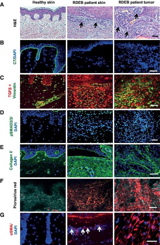 Injury-Driven Stiffening of the Dermis Expedites Skin Carcinoma ...