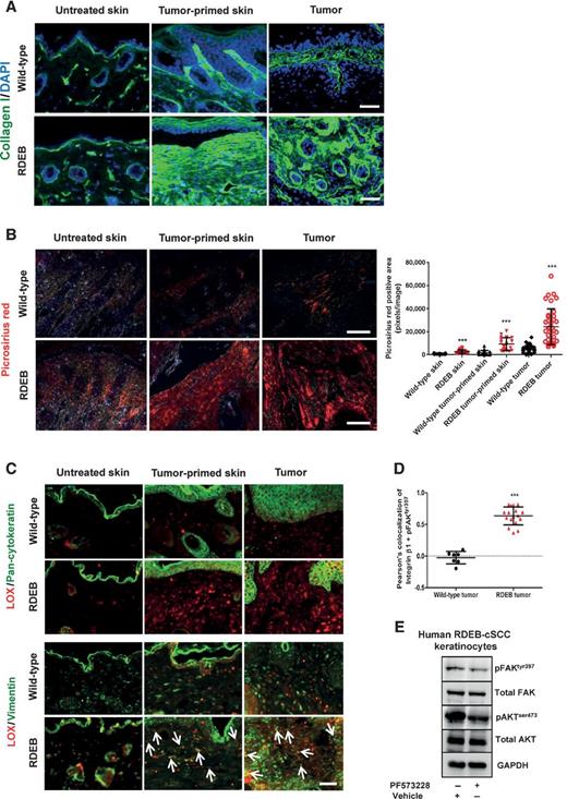 Injury-Driven Stiffening of the Dermis Expedites Skin Carcinoma ...