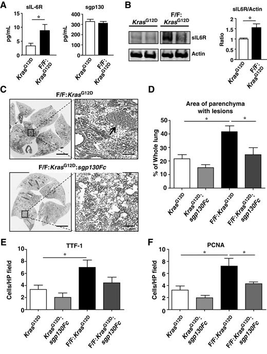 IL6 Trans-signaling Promotes KRAS-Driven Lung Carcinogenesis | Cancer ...