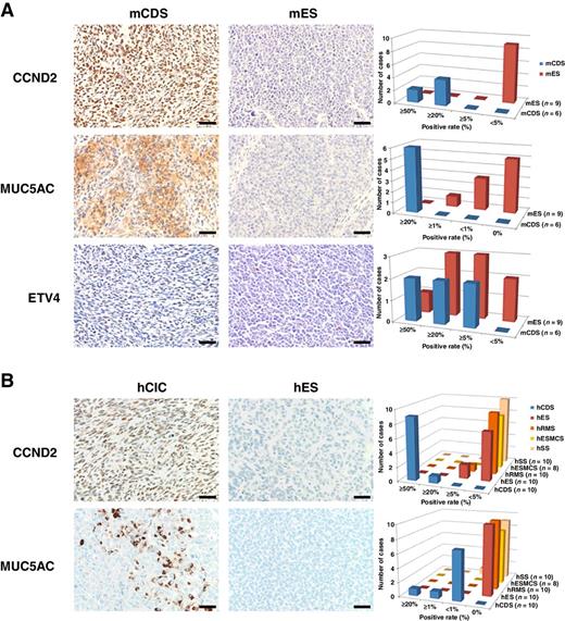 CIC-DUX4 Induces Small Round Cell Sarcomas Distinct from Ewing Sarcoma ...