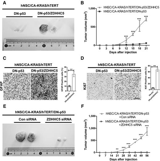EZH2 Palmitoylation Mediated by ZDHHC5 in p53-Mutant Glioma Drives ...