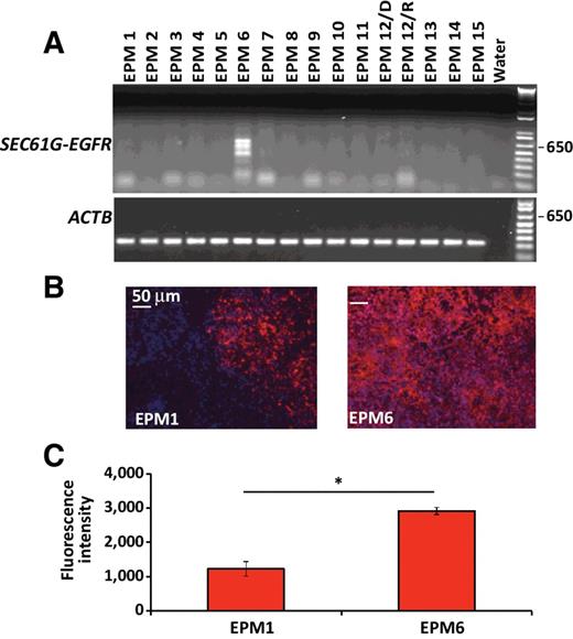 Novel SEC61G–EGFR Fusion Gene in Pediatric Ependymomas Discovered by ...