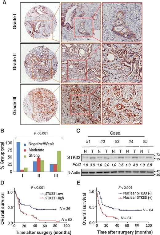 STK33 Promotes Growth and Progression of Pancreatic Cancer as a ...
