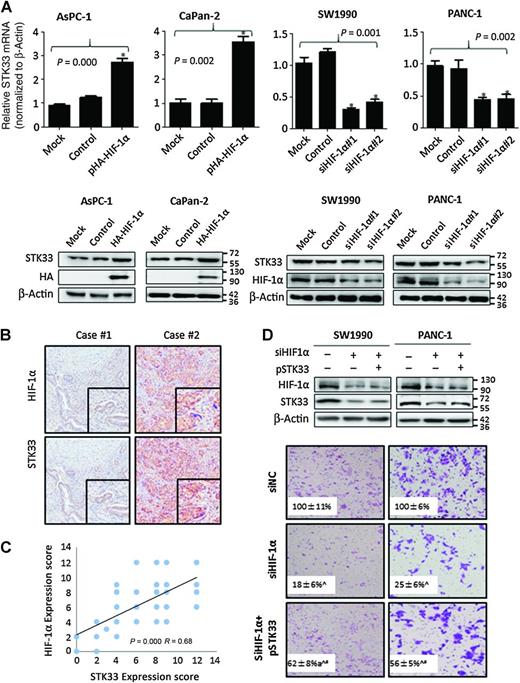 STK33 Promotes Growth and Progression of Pancreatic Cancer as a ...